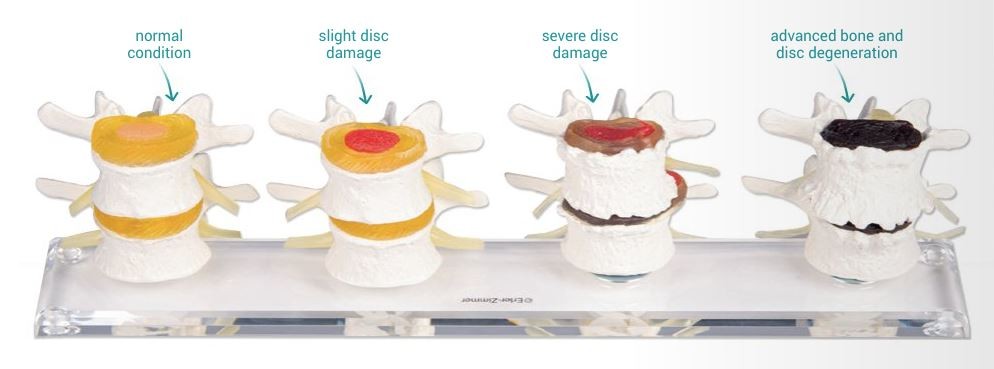 Erler-Zimmer Spinal Disc Model - MedicalSupplies.co.uk