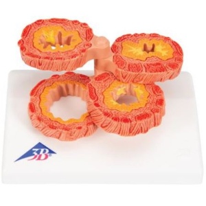 3B Scientific COPD Bronchial Tissue Model - MedicalSupplies.co.uk