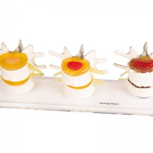 Erler-Zimmer Spinal Disc Model - MedicalSupplies.co.uk