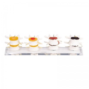Erler-Zimmer Spinal Disc Model - MedicalSupplies.co.uk