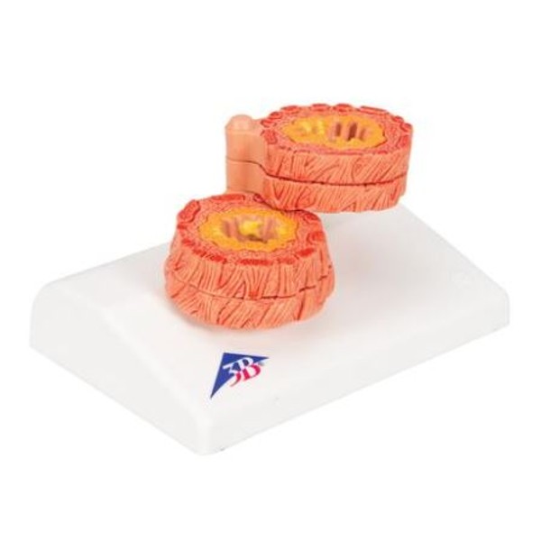 3B Scientific COPD Bronchial Tissue Model - MedicalSupplies.co.uk