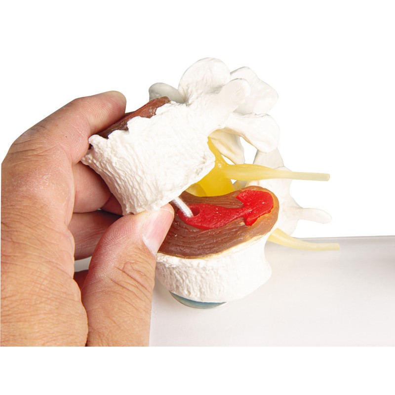 Erler-Zimmer Spinal Disc Model - MedicalSupplies.co.uk