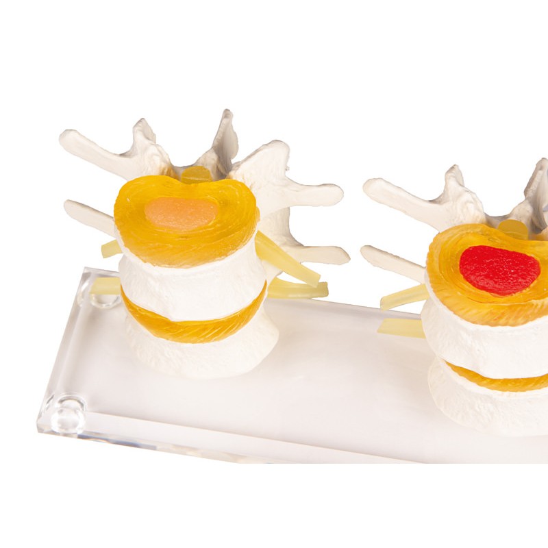 Erler-Zimmer Spinal Disc Model - MedicalSupplies.co.uk