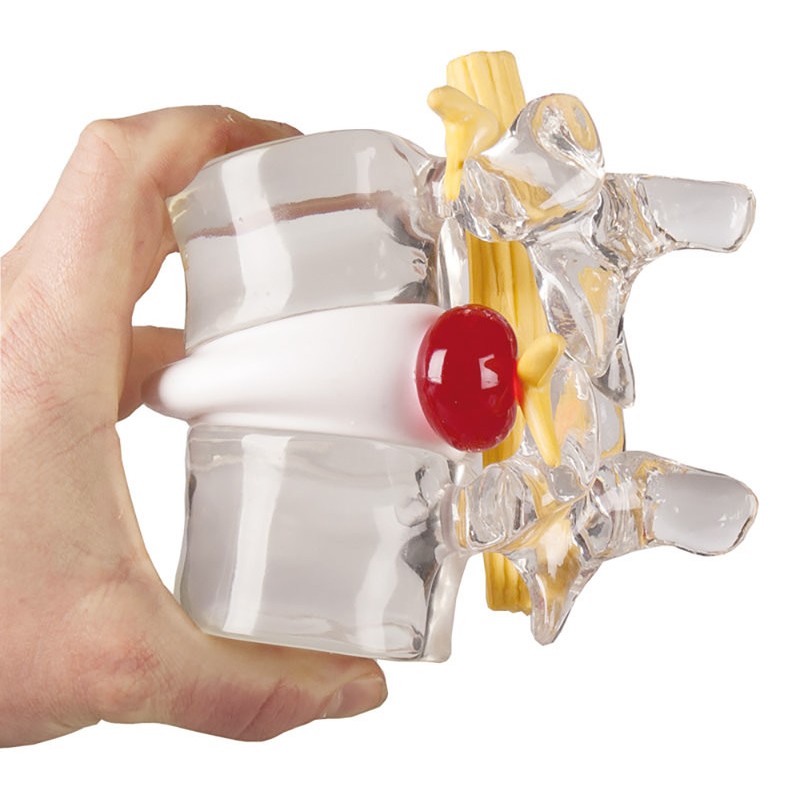 Herniated Disc Simulator Model - MedicalSupplies.co.uk