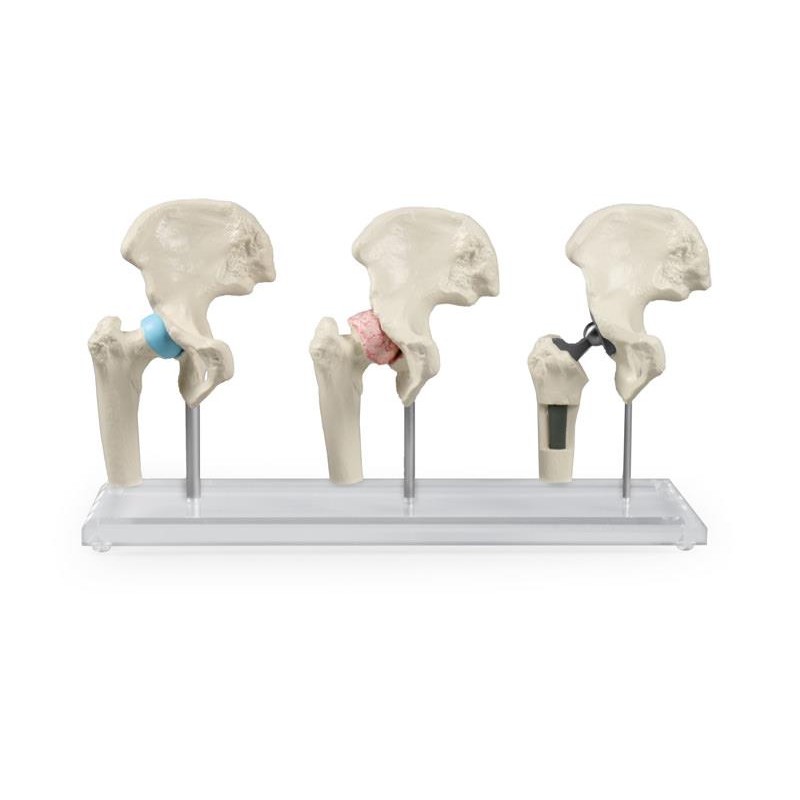 Hip Joints Model (Set of 3) - MedicalSupplies.co.uk