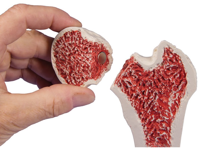 Erler-Zimmer Osteoporosis Femur Model - MedicalSupplies.co.uk