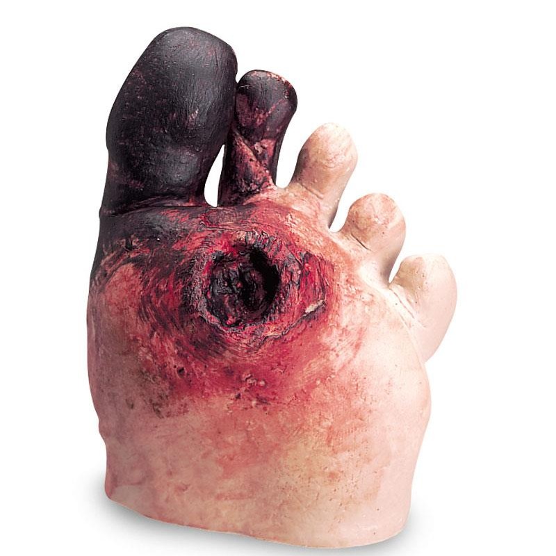 Erler-Zimmer Diabetic Foot Model - MedicalSupplies.co.uk