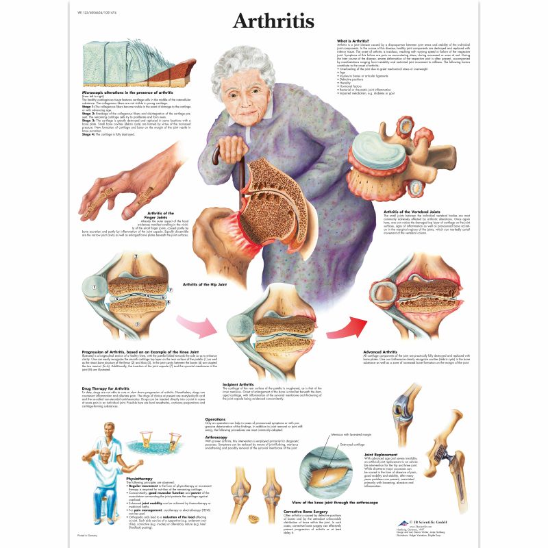 Arthritis Chart - MedicalSupplies.co.uk