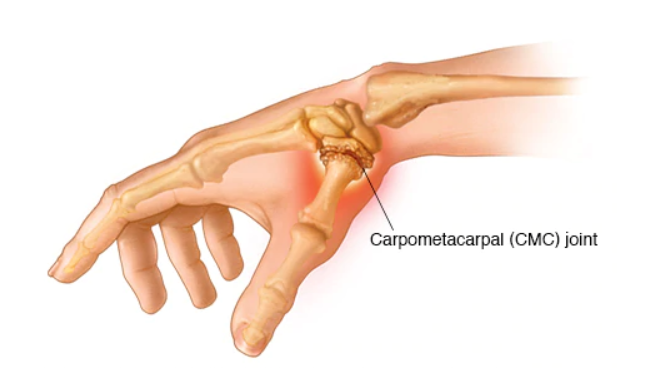 Procool Thumb Restriction CMC Splint - MedicalSupplies.co.uk