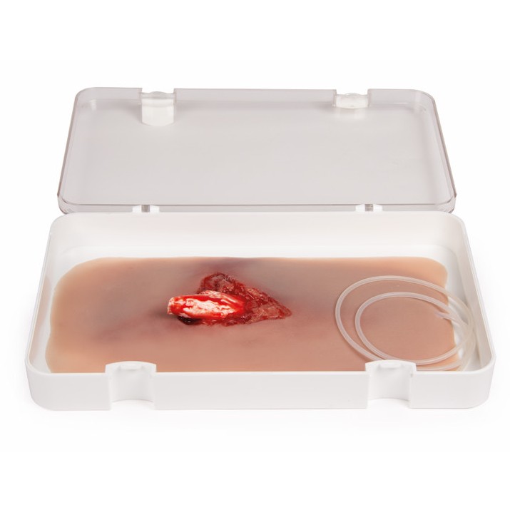 Erler Zimmer Moulage Leg Fracture Wound - MedicalSupplies.co.uk
