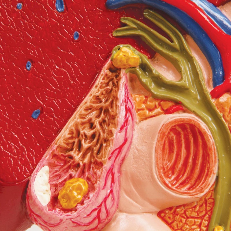 Gallstone Model - MedicalSupplies.co.uk