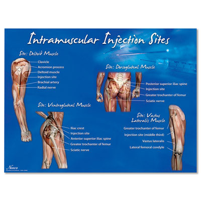 Intramuscular Injection Sites Poster - MedicalSupplies.co.uk
