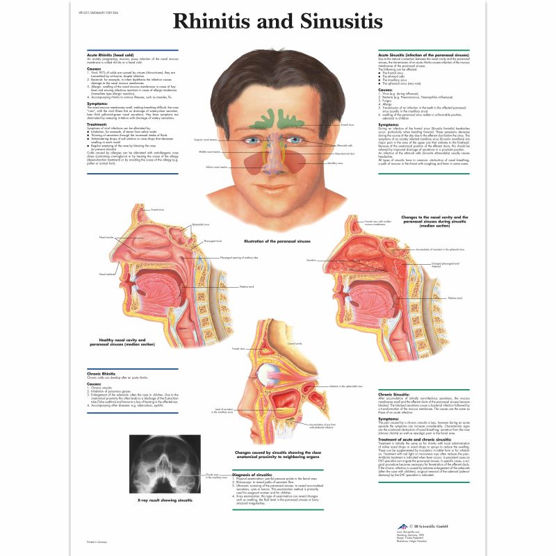 Rhinitis and Sinusitis Chart - MedicalSupplies.co.uk
