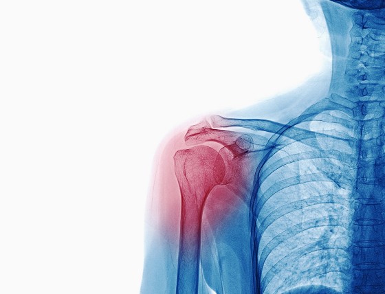 Subluxation Shoulder Brace - MedicalSupplies.co.uk