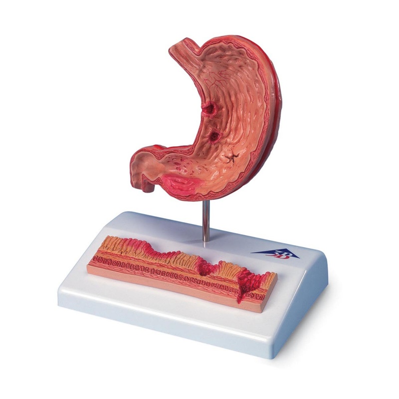 Stomach Model with Ulcers - MedicalSupplies.co.uk