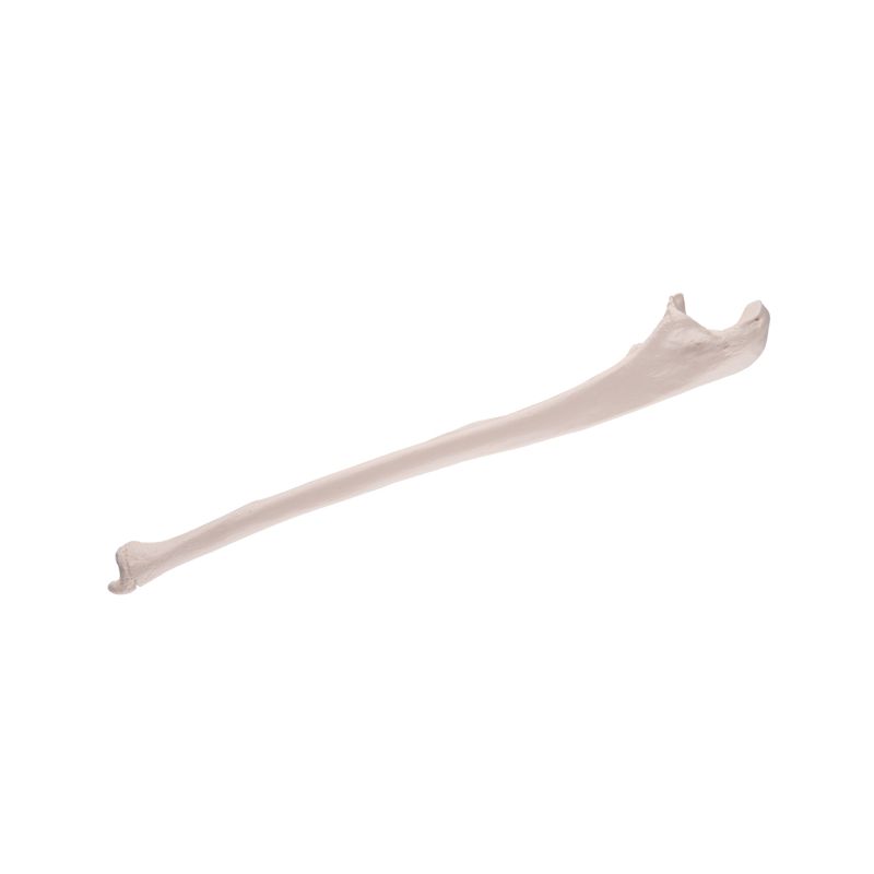 Ulna Geometrical Adaptation In Ulna And Radius Of Cerebral Palsy ...