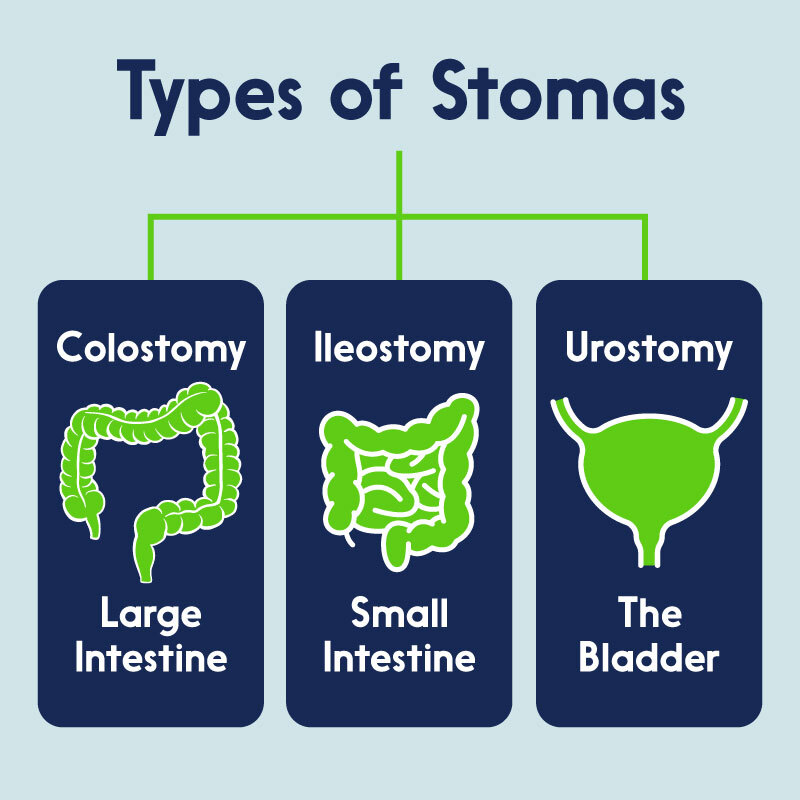 A Guide to Living With a Stoma - MedicalSupplies.co.uk
